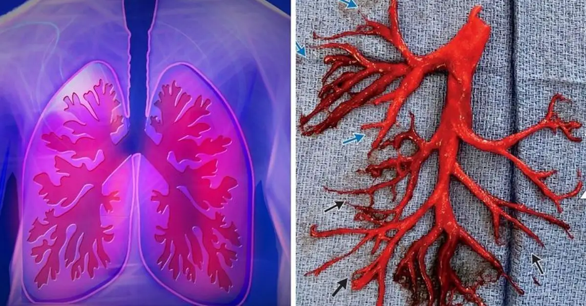 Man Coughs Up Enormous Blood Clot That Maps Out His Lungs Man Coughs Up Enormous Blood Clot That Maps Out His Lungs