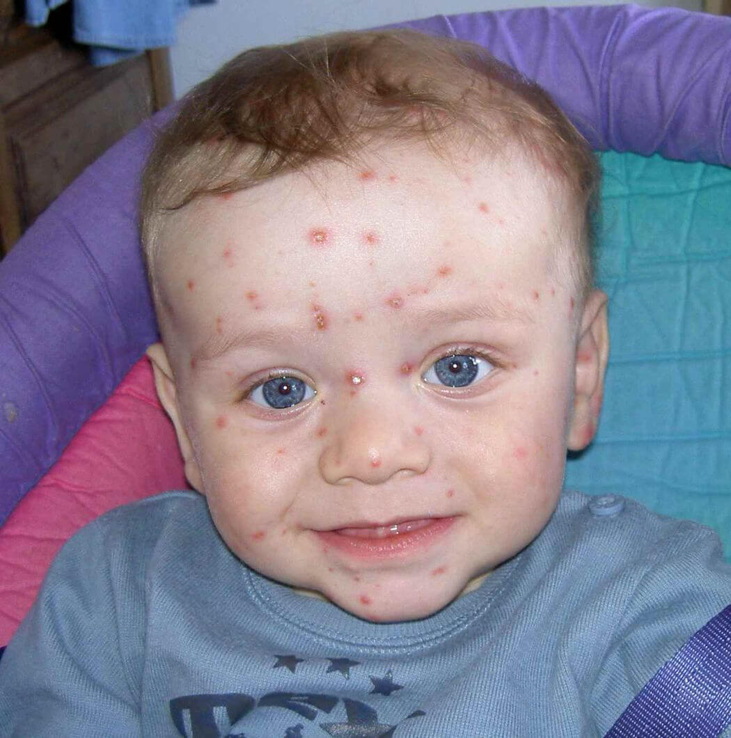 Doctors Are Warning Parents To Avoid Trendy Chickenpox Parties
