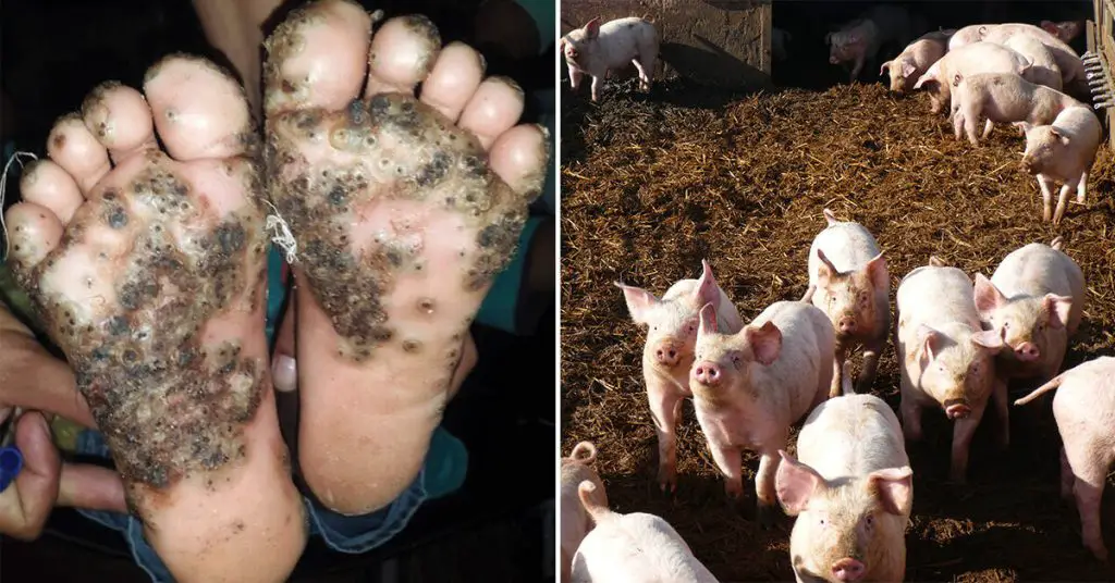 Girl's Barefoot Run Through Pigsty Causes Foot Infection