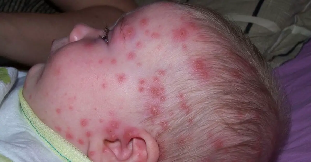 Doctors Are Warning Parents To Avoid Trendy Chickenpox Parties