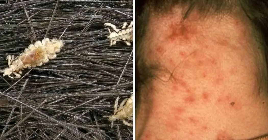 12 Common Bug Bites And How To Recognize Each One